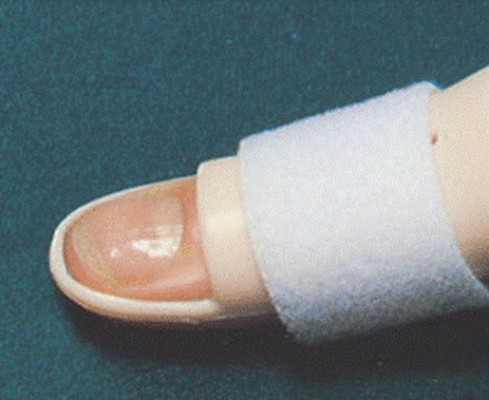 Stack´sche Fingerschiene – Orthopädie Technik Zentrum