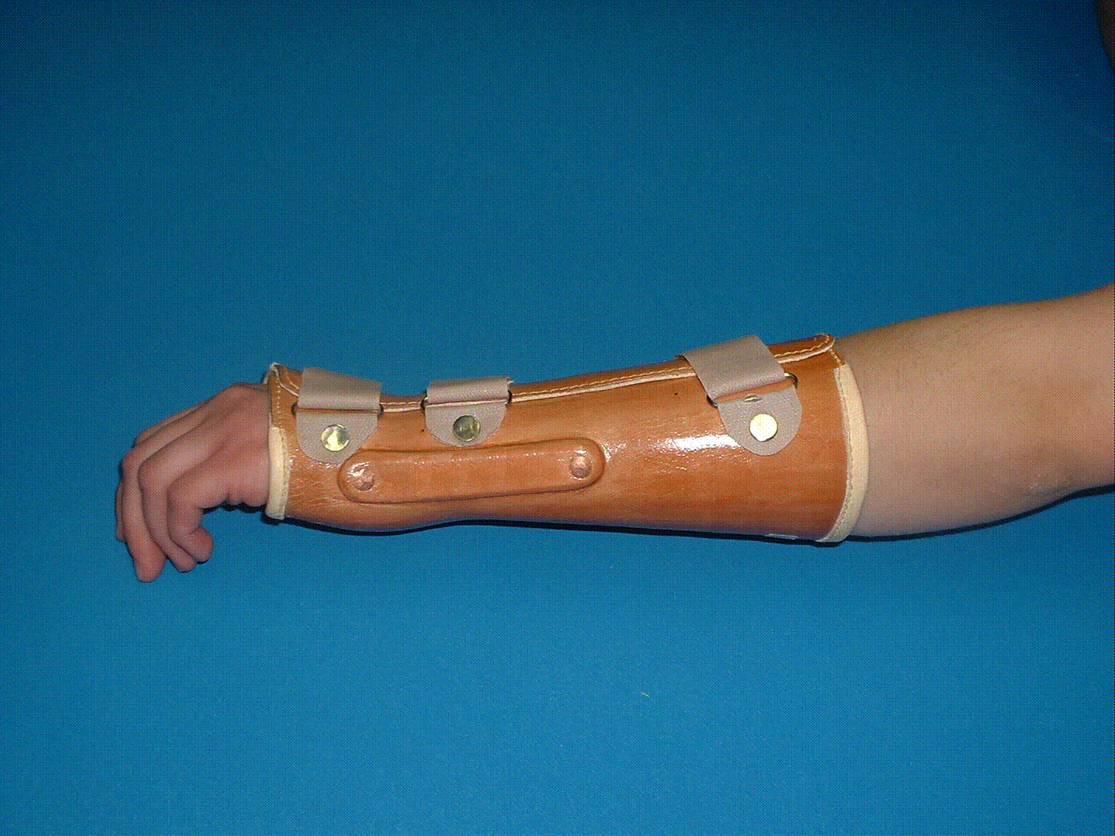 Mittelhand-Unterarmhülse mit oder ohne Daumeneinschluss nach Gipsmodell ...