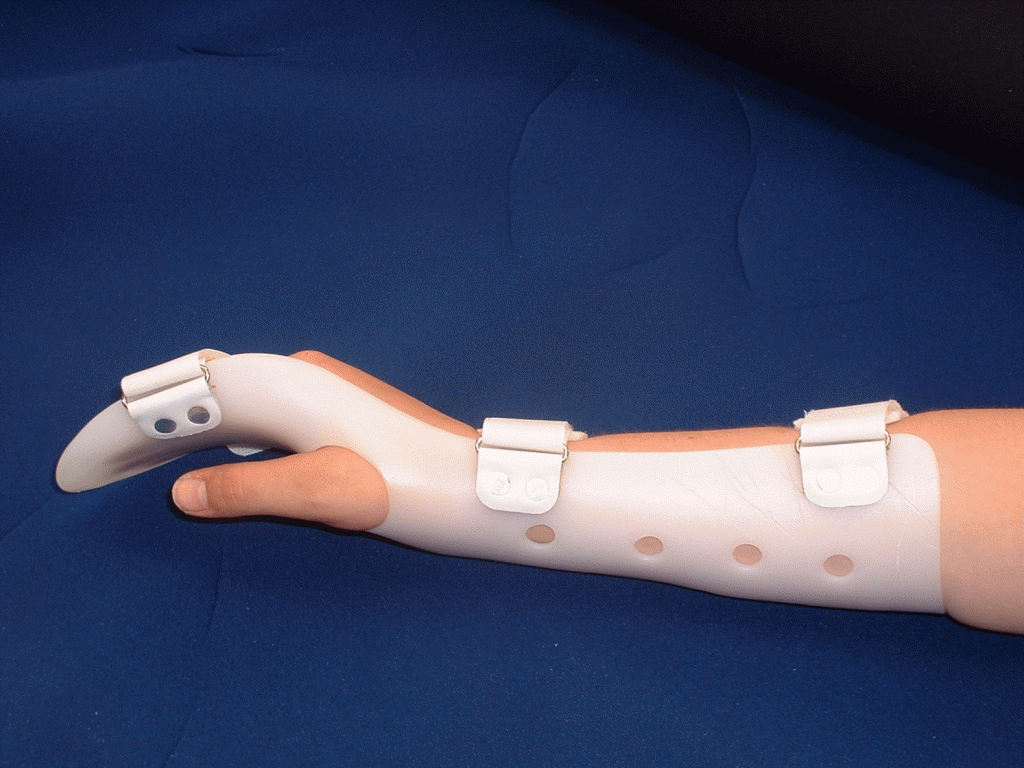 Volare UA-Schiene mit oder ohne Daumeneischluß nach Gipsmodell ...